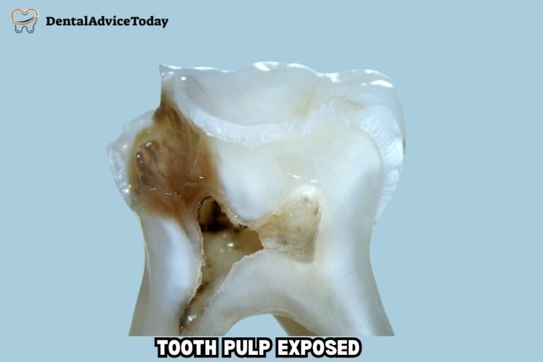 Tooth Pulp Exposed: Causes, Symptoms, and Treatment